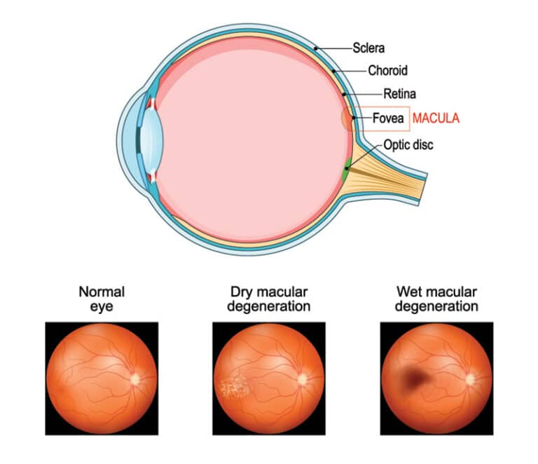 Macular Degeneration Wooster | AMD Treatments Wooster, Ohio